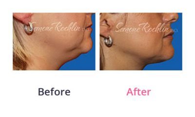 Liposuction Before and After Photos | Dr. Semone Rochlin