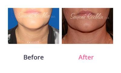 Liposuction Before and After Photos | Dr. Semone Rochlin
