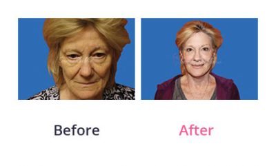 Before and After Photos Mini Facelift | Dr. Semone Rochlin